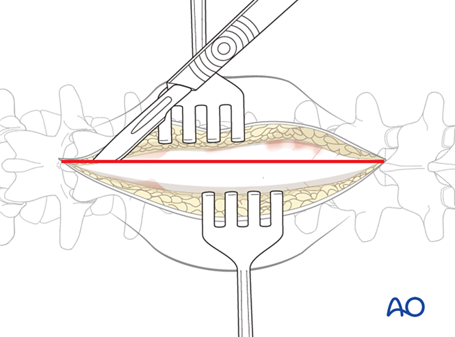 Posterior midline access to the thoracolumbar spine (T1–L5)