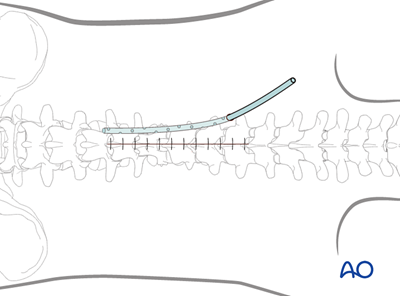 Posterior midline access to the thoracolumbar spine (T1–L5)