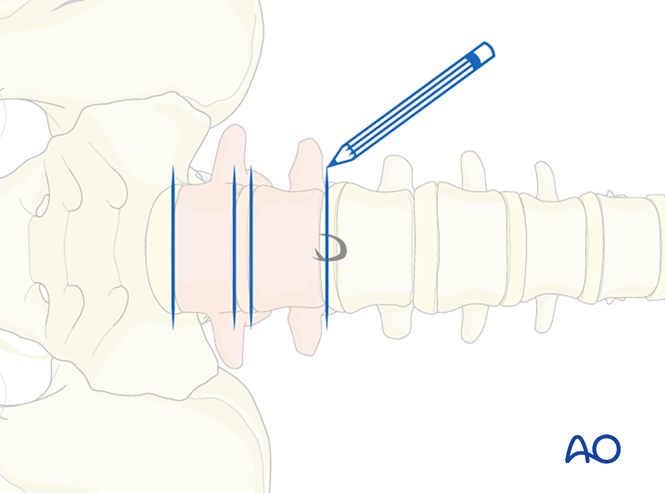 Retroperitoneal approach (L4–S1)