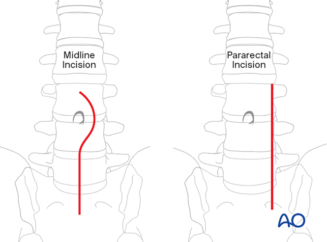 Retroperitoneal approach (L4–S1)