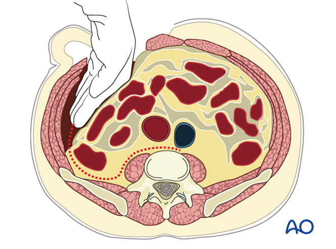 Retroperitoneal approach (L4–S1)