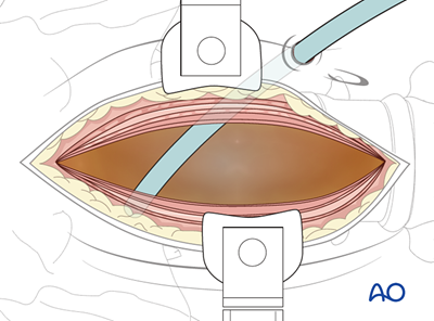 Retroperitoneal approach (L4–S1)