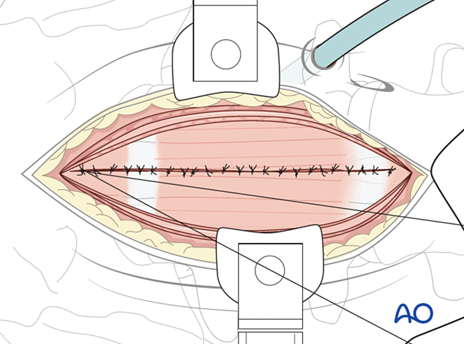 Retroperitoneal approach (L4–S1)
