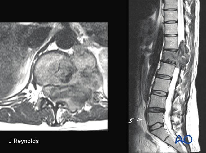 New module - Spine primary tumors