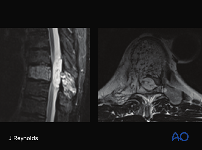 Benign tumors C1 to C7