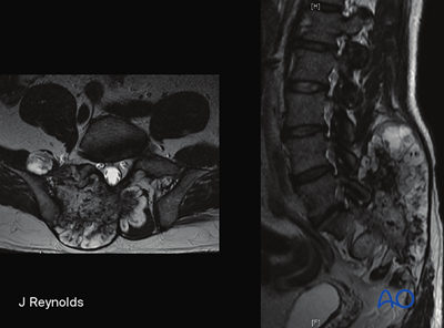 Malignant tumors L1 to L5