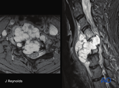 Malignant tumors L1 to L5