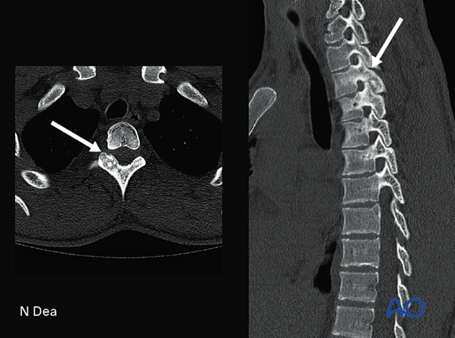Observation and analgesics for Benign sacral tumors