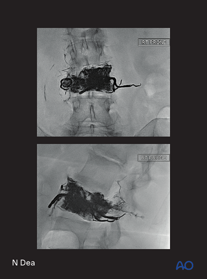 Percutaneous treatment (embolization) for Benign sacral tumors