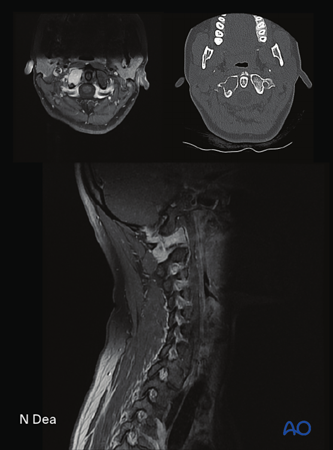 Intralesional resection (C0 to C2) for Benign cervical tumors