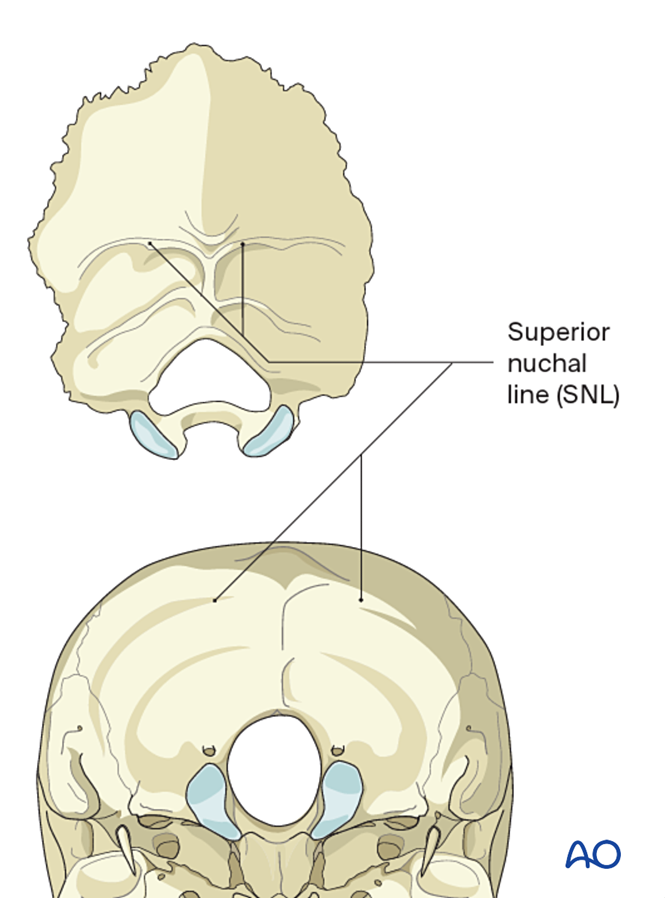 Occipitocervical fusion IIC for Region II Type C: Translation injury of ...