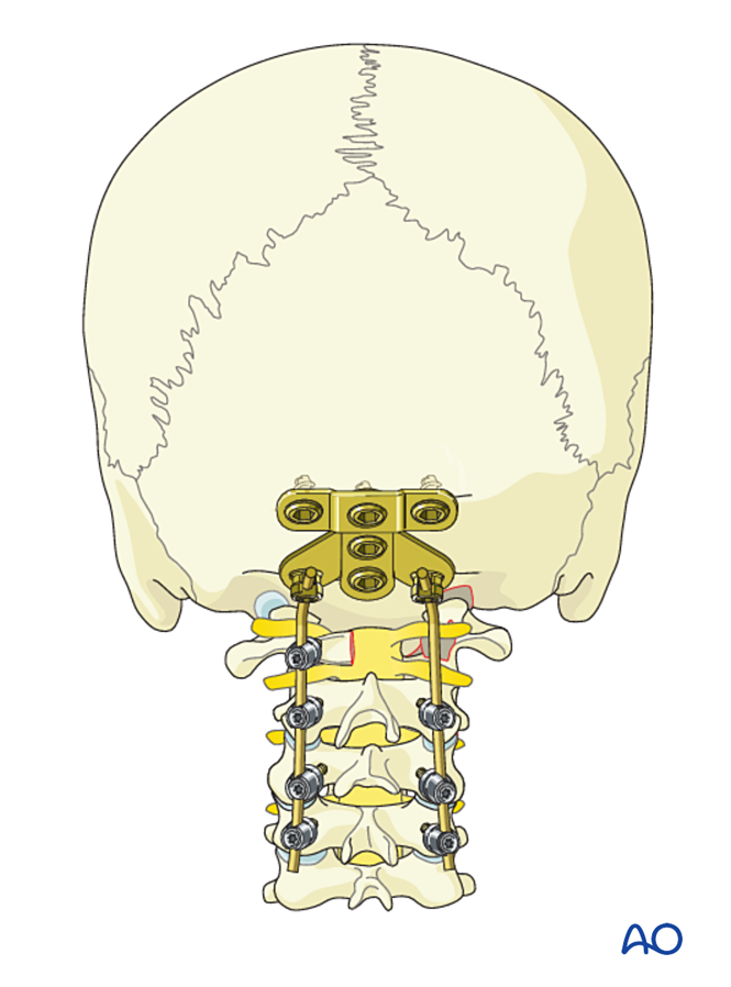 Intralesional resection (C0 to C2) for Benign cervical tumors