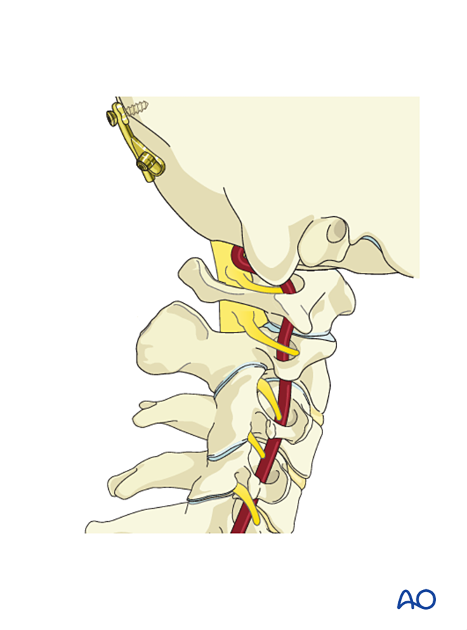 Intralesional resection (C0 to C2) for Benign cervical tumors