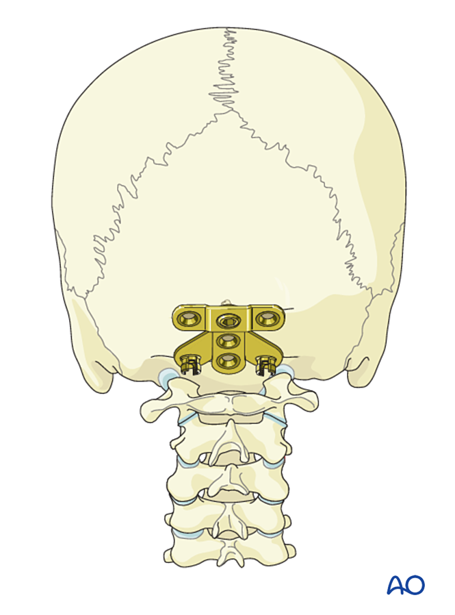 Intralesional resection (C0 to C2) for Benign cervical tumors