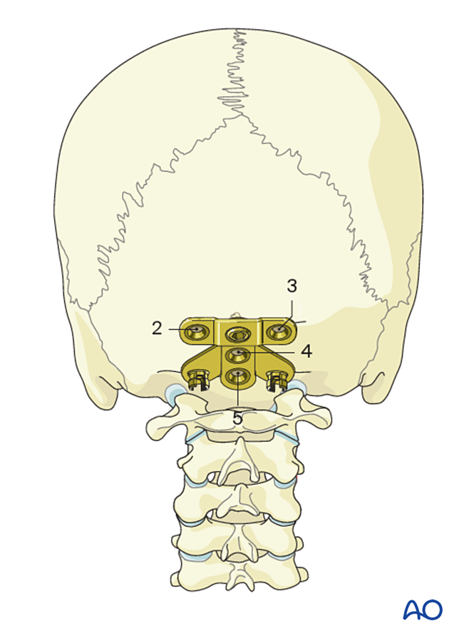 Intralesional resection (C0 to C2) for Benign cervical tumors