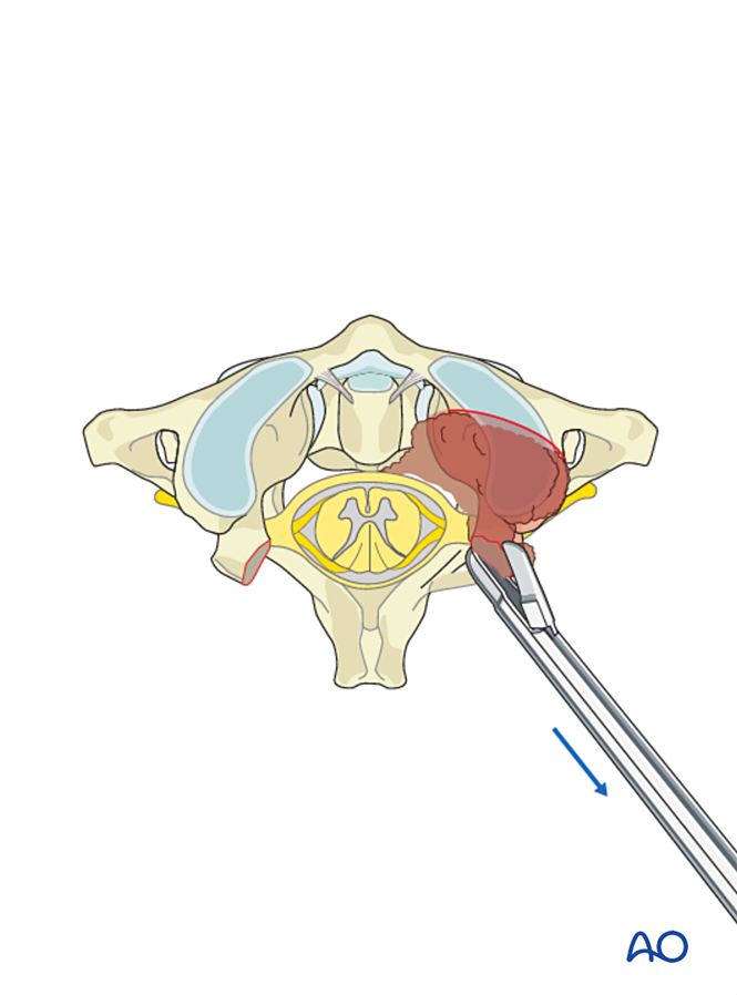 Intralesional resection (C0 to C2) for Benign cervical tumors