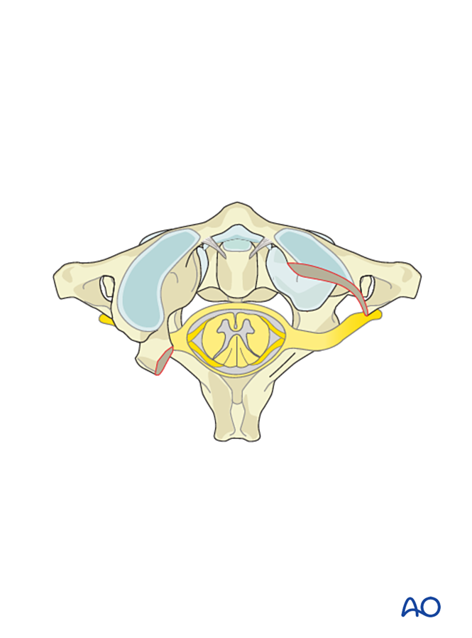 Intralesional resection (C0 to C2) for Benign cervical tumors