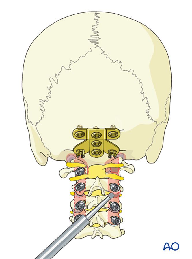 Instrumentation for occipitocervical fixation