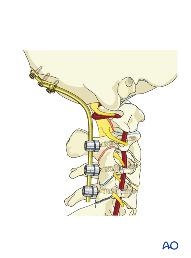 Intralesional resection (C0 to C2) for Benign cervical tumors