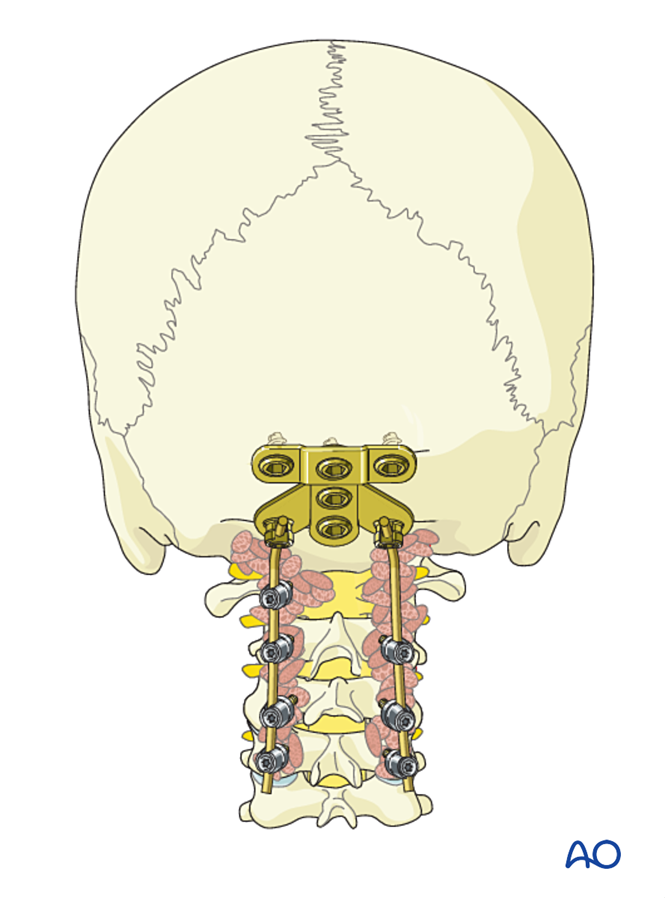 En bloc resection of an anterior tumor (C1 to C7) for Benign cervical ...