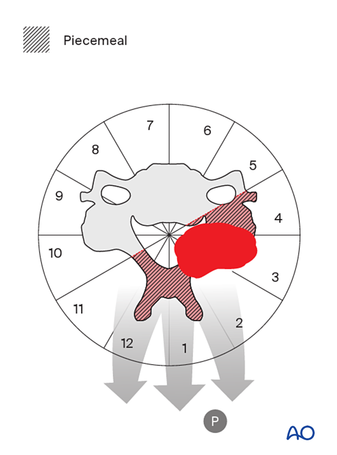 Intralesional resection (C3 to C7) for Benign cervical tumors