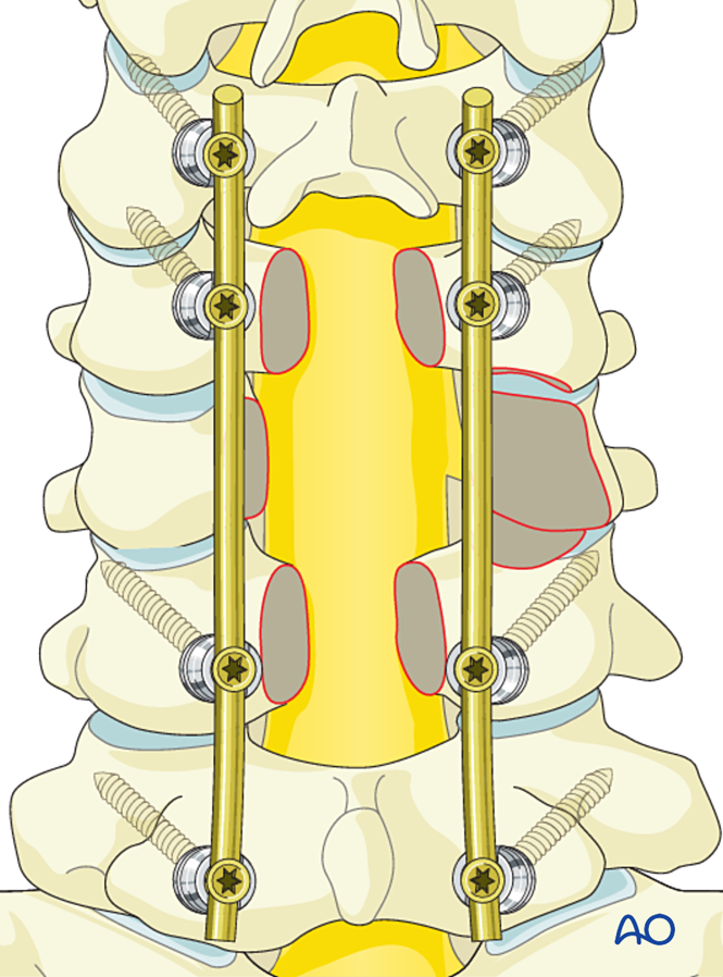 Intralesional resection (C3 to C7) for Benign cervical tumors