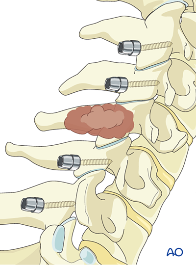 Intralesional resection (C3 to C7) for Benign cervical tumors