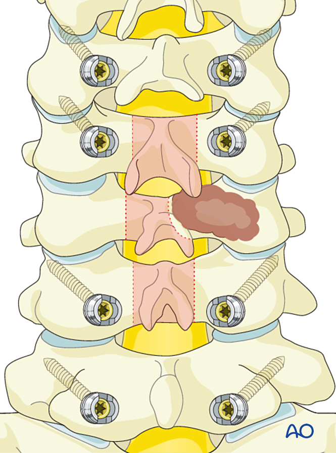 Intralesional resection (C3 to C7) for Benign cervical tumors