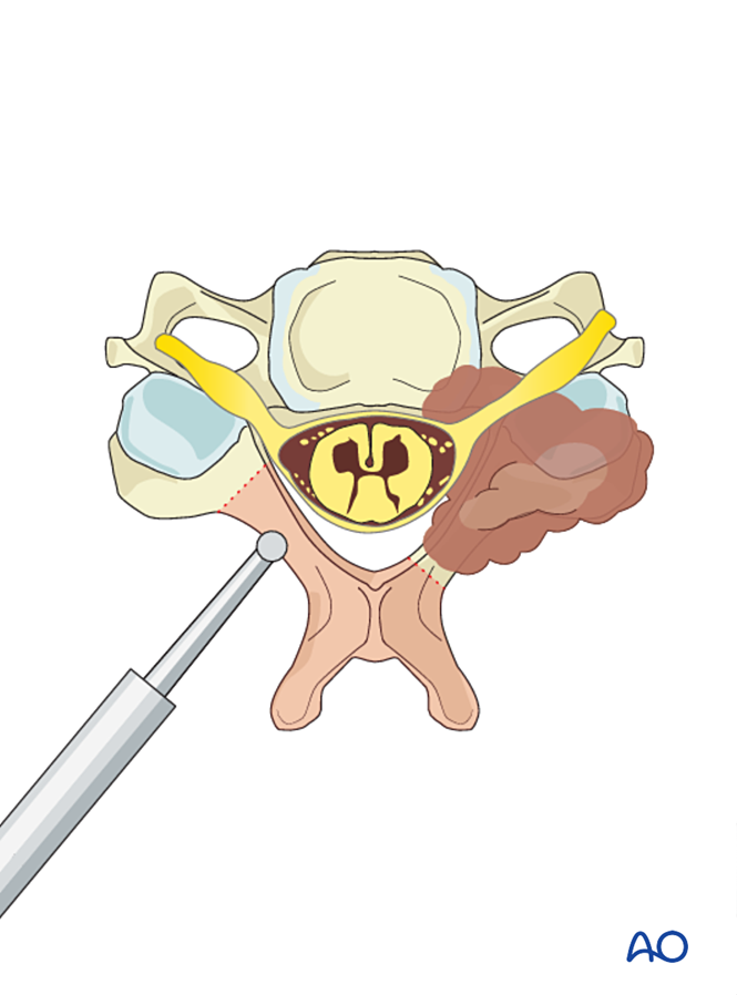 Intralesional resection (C3 to C7) for Benign cervical tumors