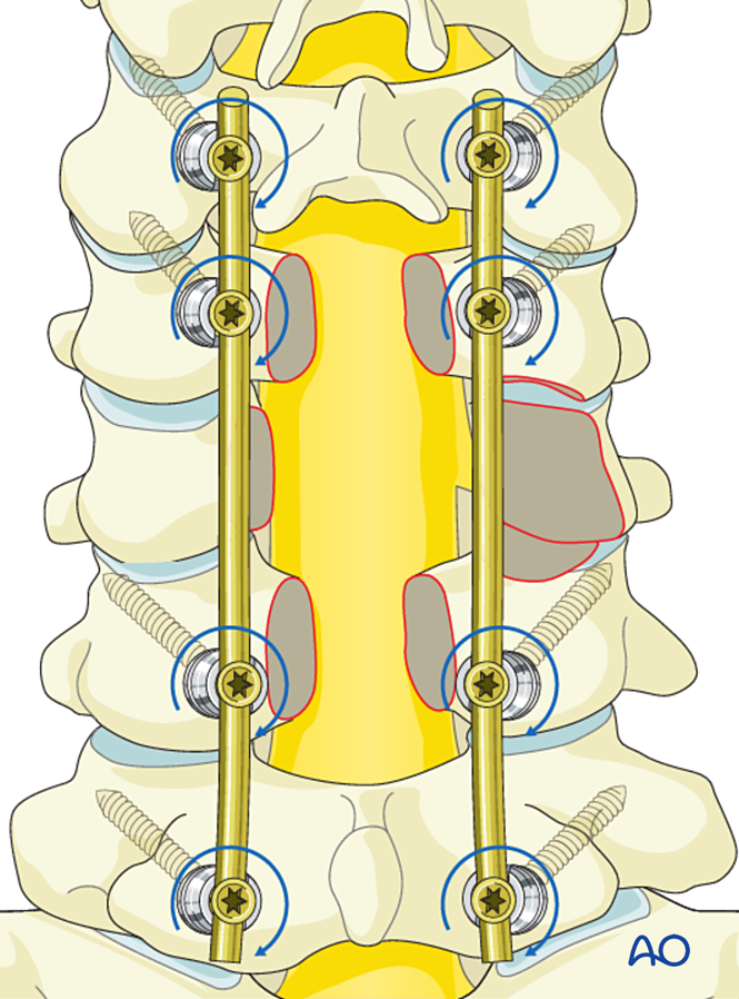 Intralesional resection (C3 to C7) for Benign cervical tumors