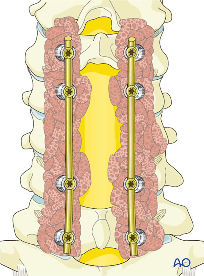 Intralesional resection (C3 to C7) for Benign cervical tumors