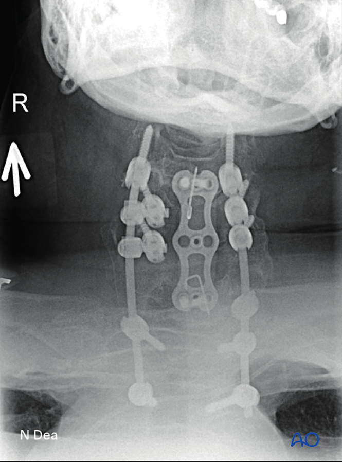 Intralesional resection (C3 to C7) for Benign cervical tumors