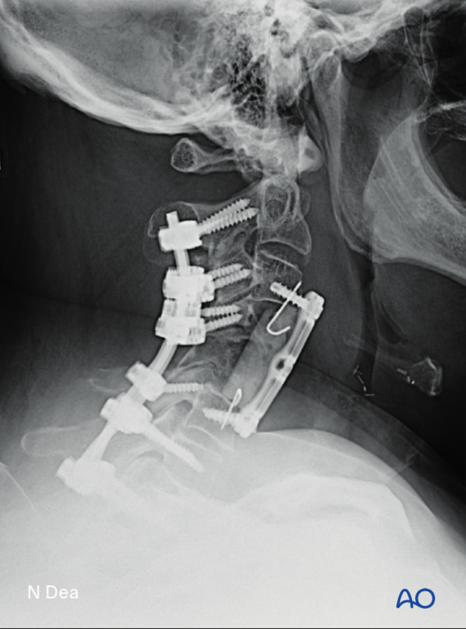 Intralesional resection (C3 to C7) for Benign cervical tumors