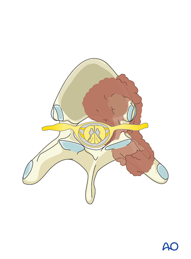 Intralesional resection (T1 to T12) for Benign thoracic tumors
