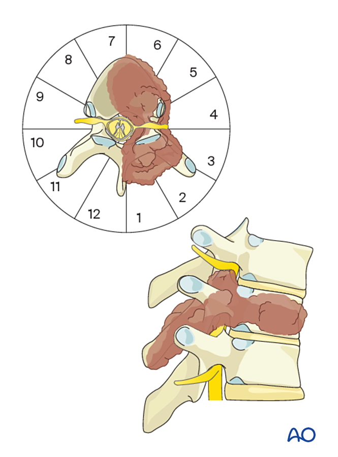 Intralesional resection (T1 to T12) for Benign thoracic tumors