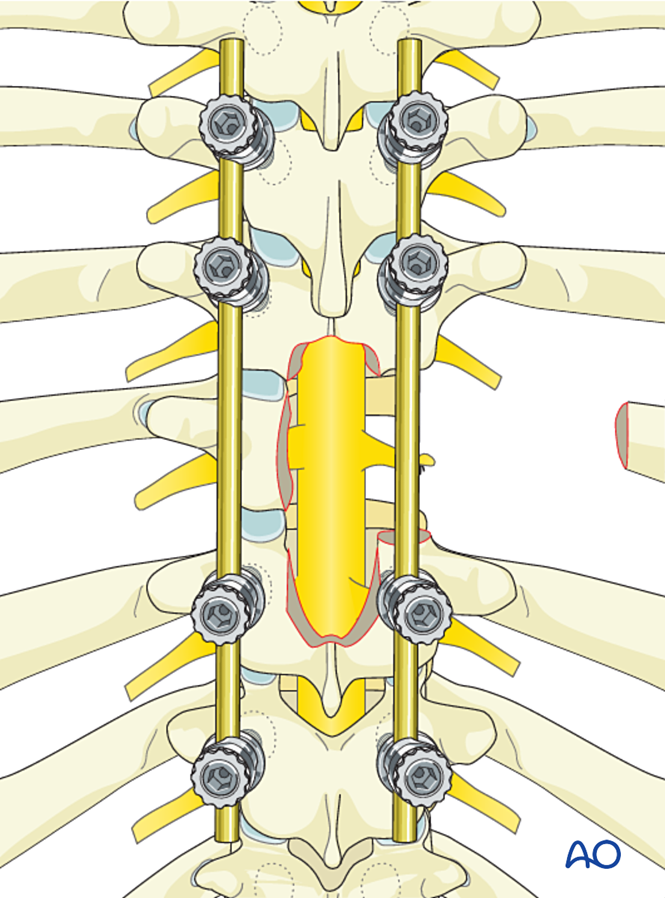 Intralesional resection (T1 to T12) for Benign thoracic tumors