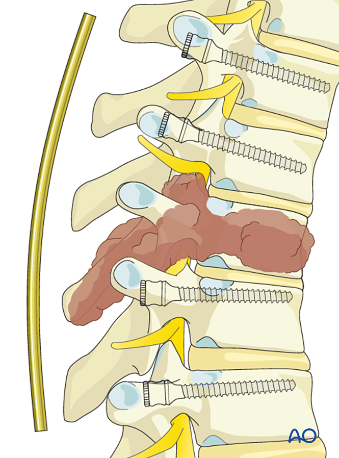 Intralesional resection (T1 to T12) for Benign thoracic tumors
