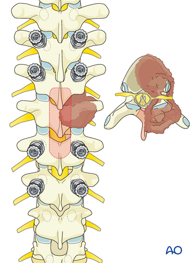 Intralesional resection (T1 to T12) for Benign thoracic tumors