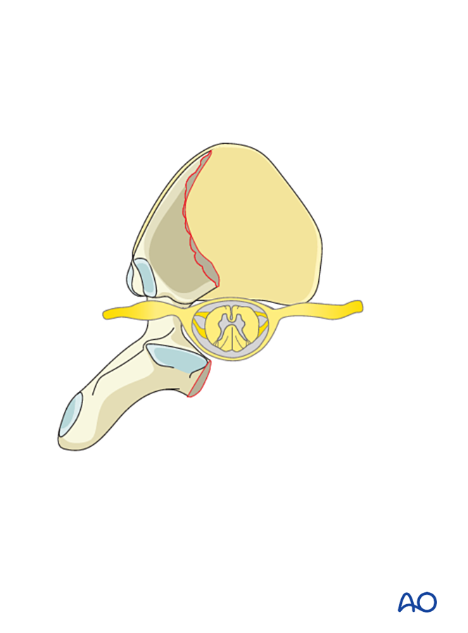 Intralesional resection (T1 to T12) for Benign thoracic tumors