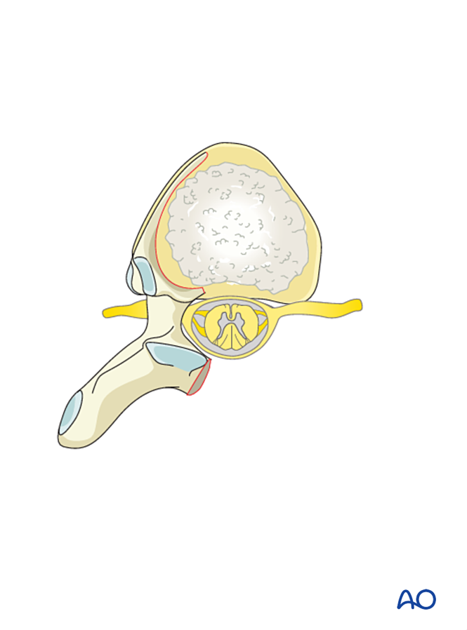 Intralesional resection (T1 to T12) for Benign thoracic tumors