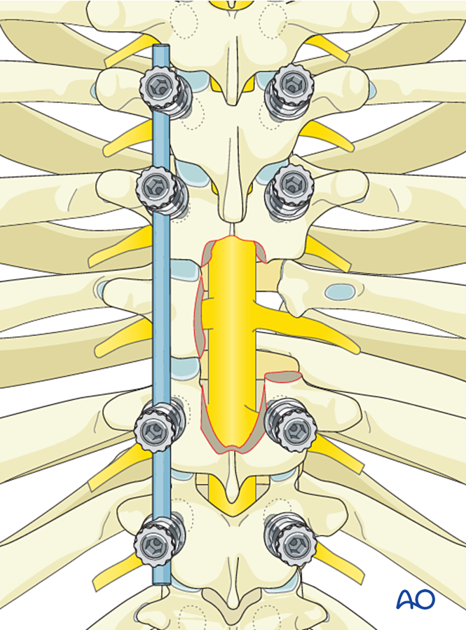 Intralesional resection (T1 to T12) for Benign thoracic tumors