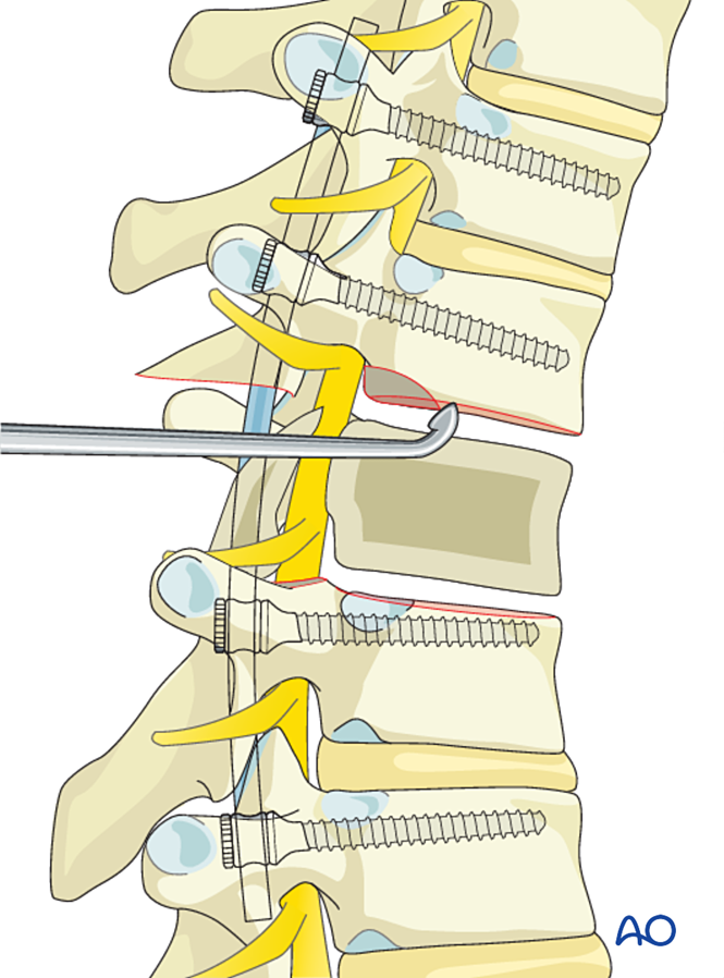 Intralesional resection (T1 to T12) for Benign thoracic tumors