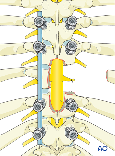 Intralesional resection (T1 to T12) for Benign thoracic tumors