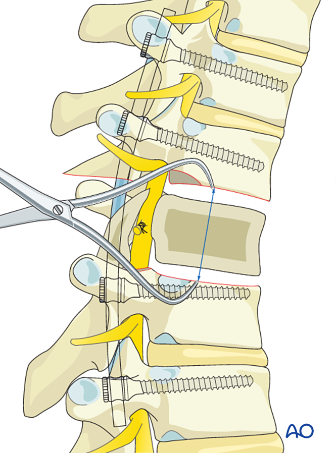 Intralesional resection (T1 to T12) for Benign thoracic tumors