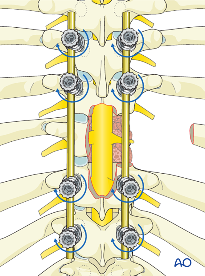 Intralesional resection (T1 to T12) for Benign thoracic tumors