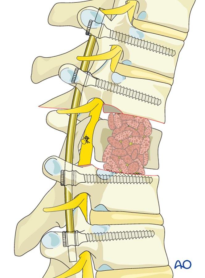 Intralesional resection (T1 to T12) for Benign thoracic tumors