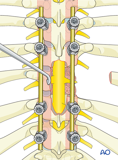 Intralesional resection (T1 to T12) for Benign thoracic tumors