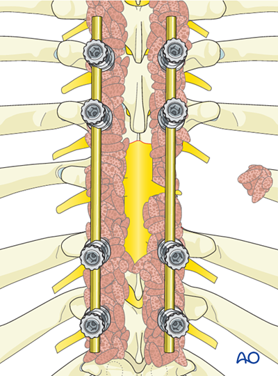Intralesional resection (T1 to T12) for Benign thoracic tumors