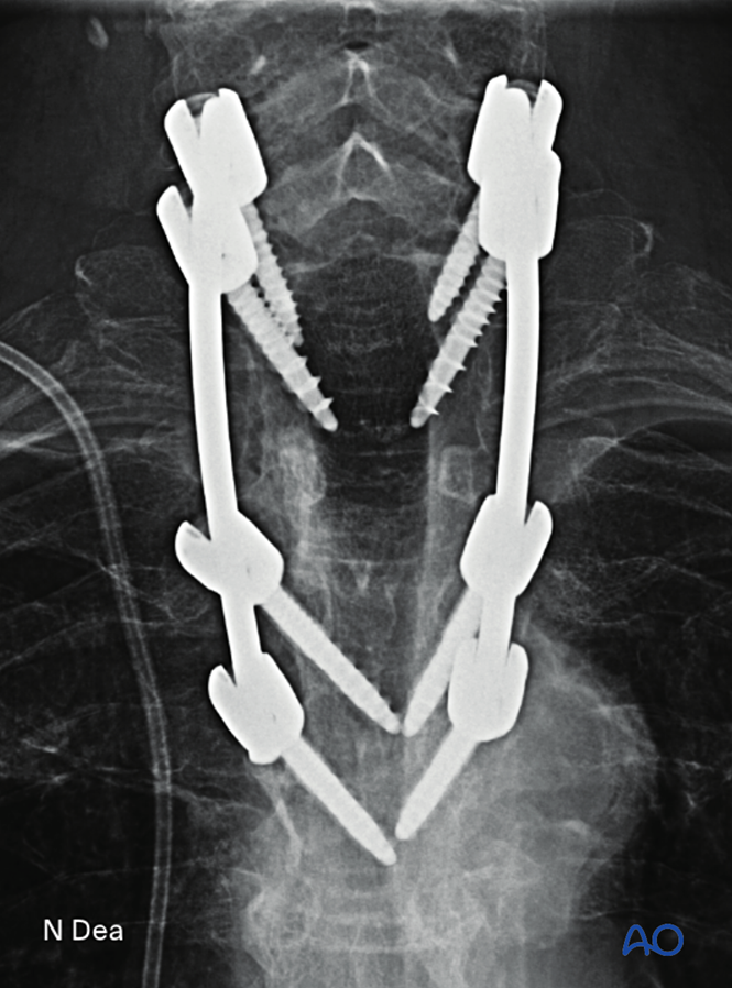 Intralesional resection (T1 to T12) for Benign thoracic tumors