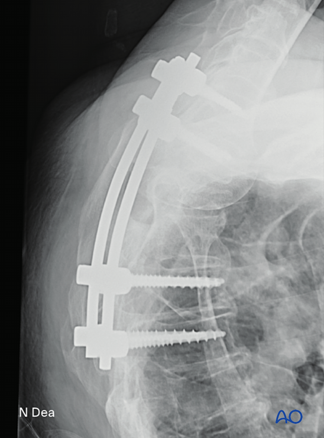 Intralesional resection (T1 to T12) for Benign thoracic tumors